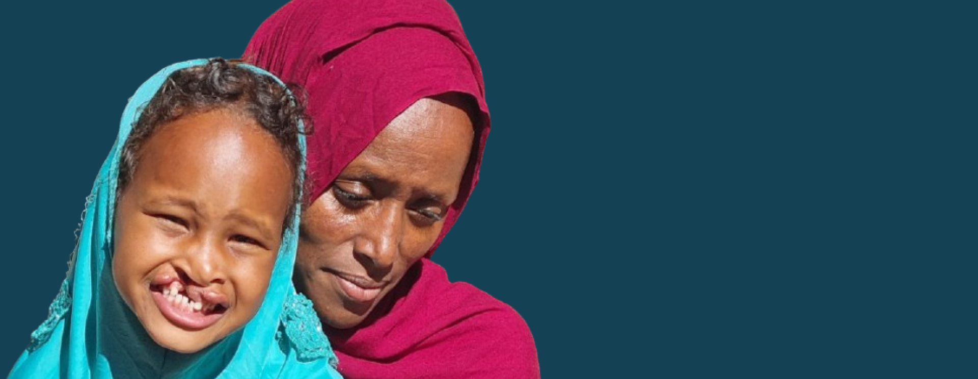 Children with cleft lip and palate in Jijiga Äthiopien - Somcare